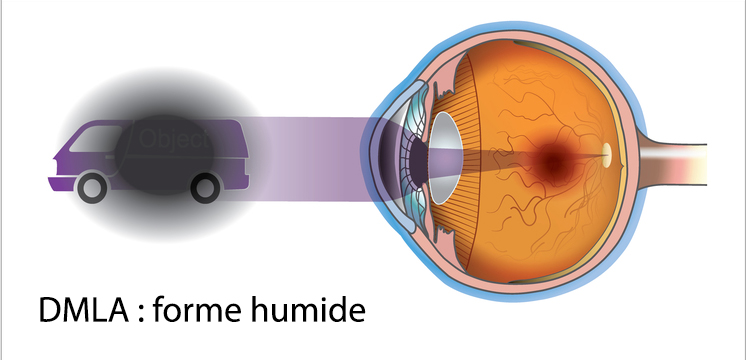 DMLA : les traitements | Visiopôle du Beaujolais | Villefranche-sur-Saône