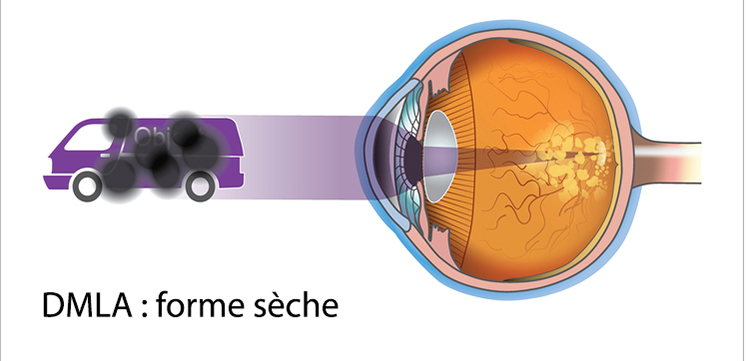 DMLA : les traitements | Visiopôle du Beaujolais | Villefranche-sur-Saône