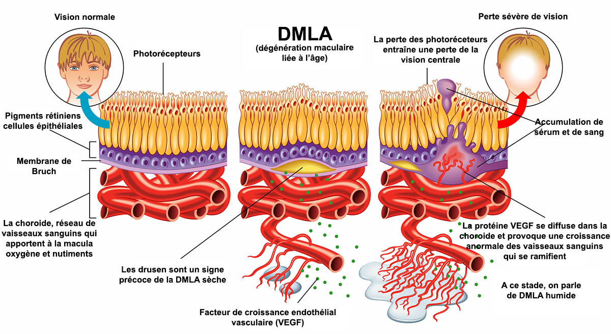DMLA - Visiopôle du Beaujolais