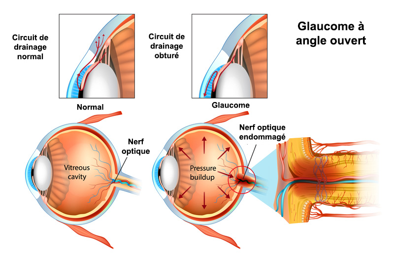 Glaucome : pathologie | Visiopôle du Beaujolais | Villefranche-sur-Saône
