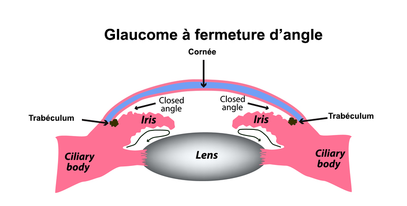 Glaucome : pathologie | Visiopôle du Beaujolais | Villefranche-sur-Saône
