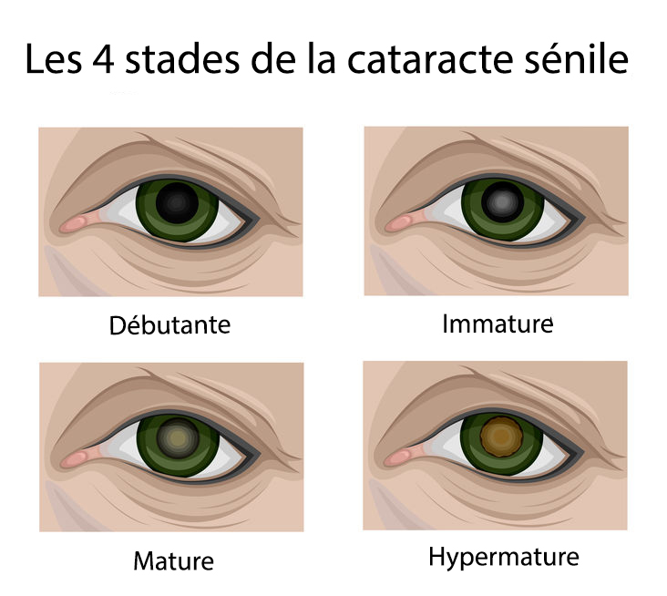 Opération de la cataracte | Visiopôle du Beaujolais | Villefranche-sur ...